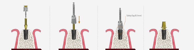 BONE PROFILER KIT | PLANMED
